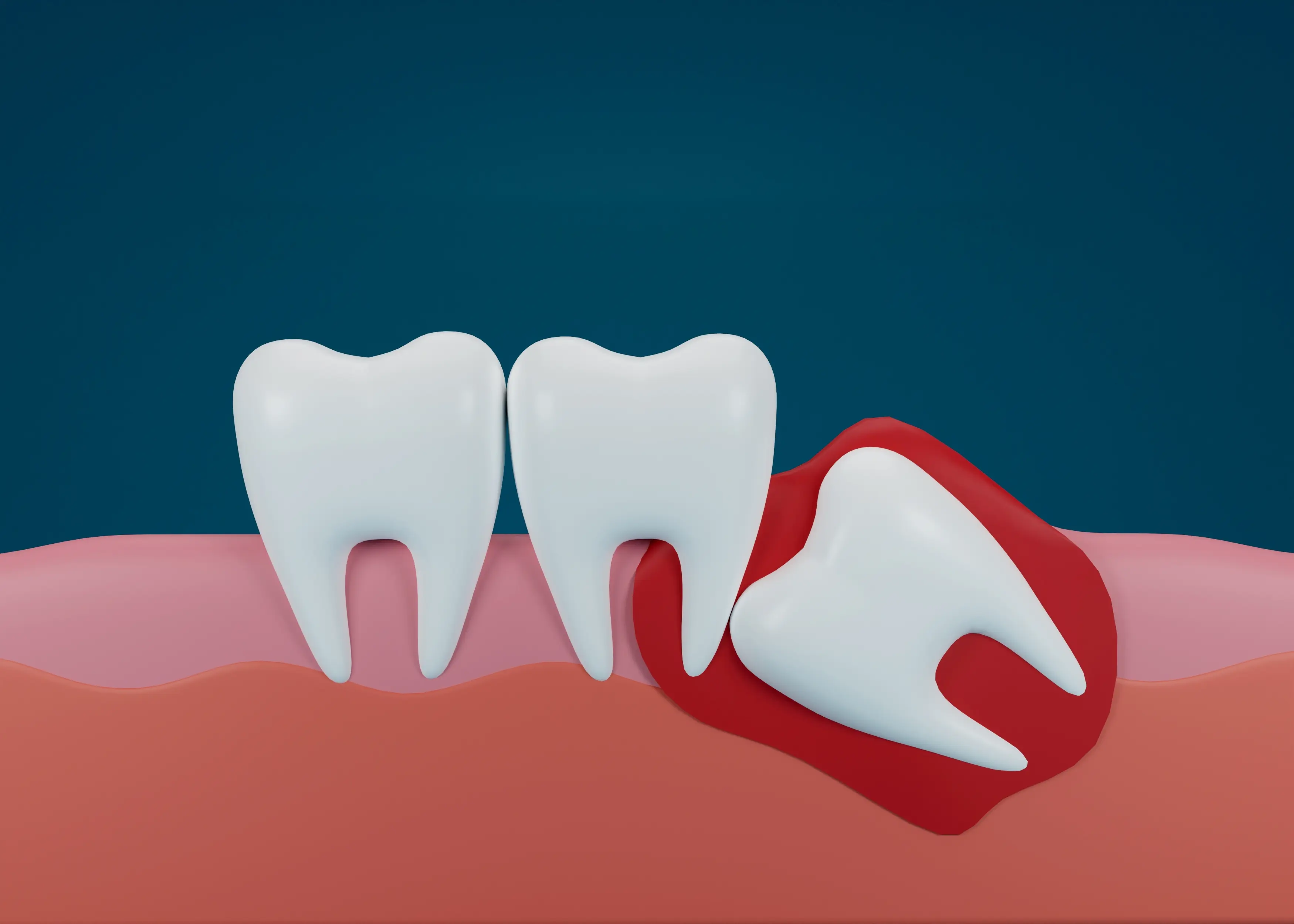 Impacted Wisdom Teeth: Symptoms and Treatment - Dentique Dental Clinic