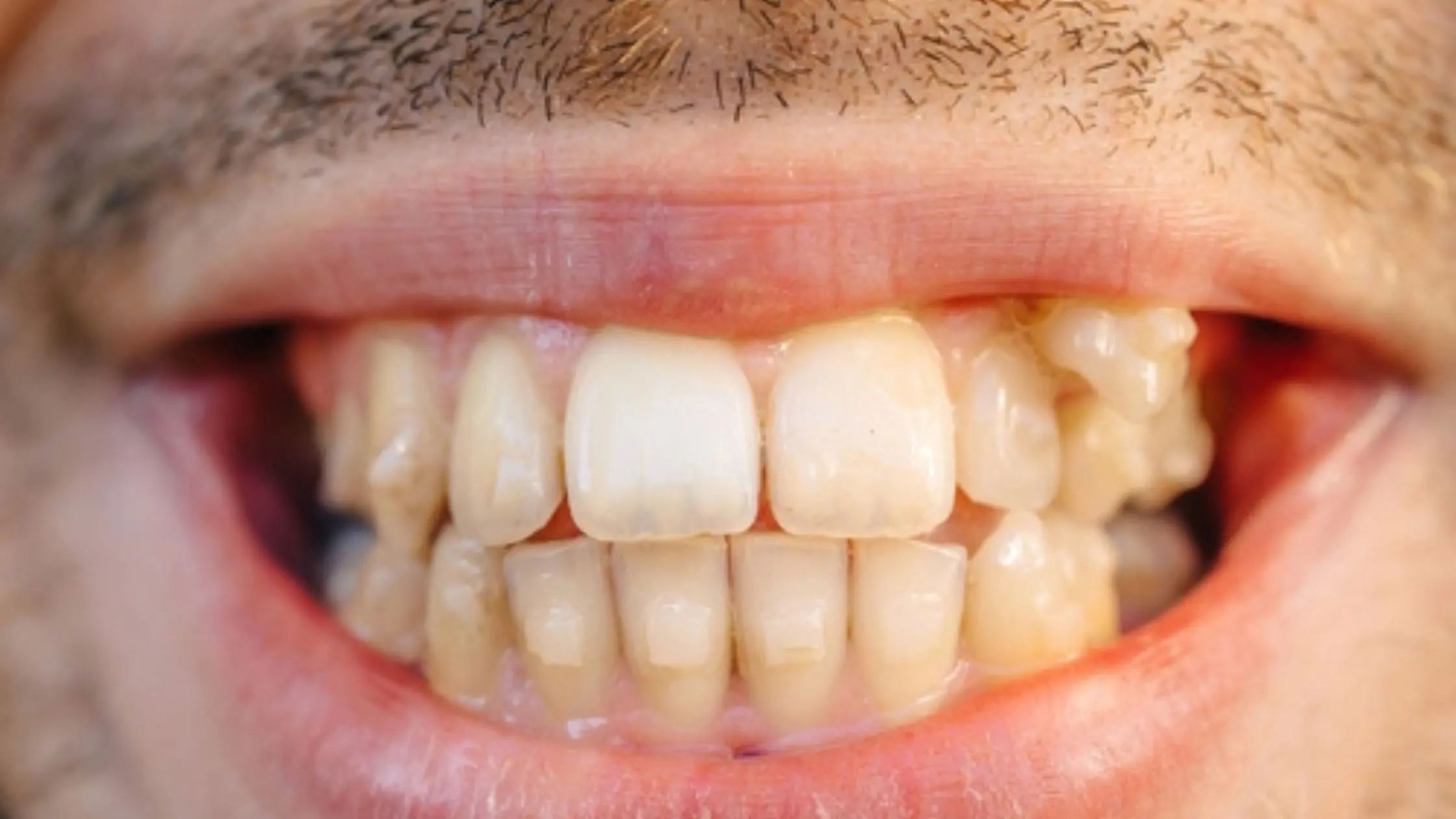 What are Invisalign Attachments and When They are Needed? Denique ...